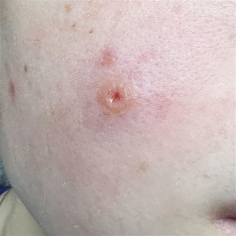 Popped A Pimple Underneath My Beauty Markmole And Now Its Gone The