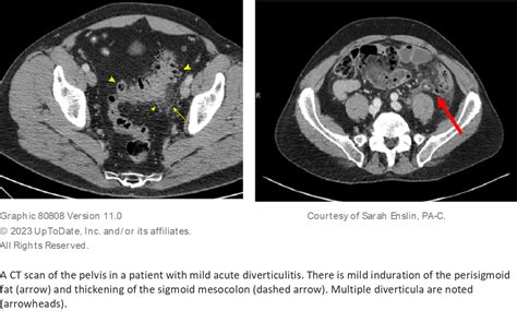 Asge Case 8 Acute Uncomplicated Diverticulitis
