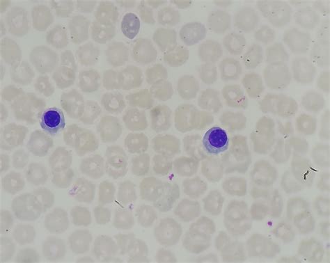 Eritroblastoortocromático Son Hematología Clínica