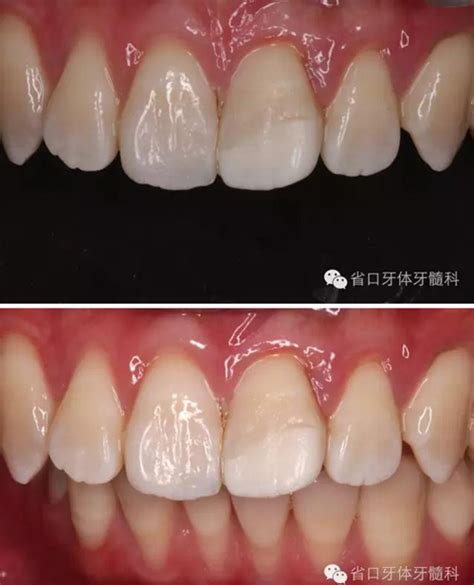 前牙断冠再接1例 科贸嘉友收录美学修复陕西嘉友科贸有限公司