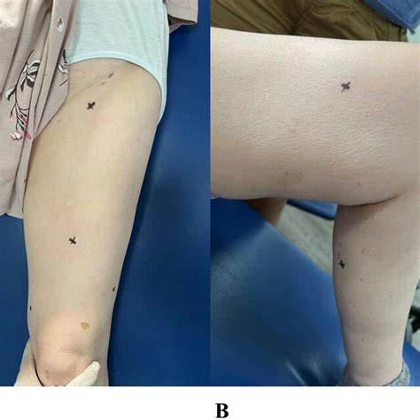 Treatment Sites A Myofascial Trigger Points Mtrps On The