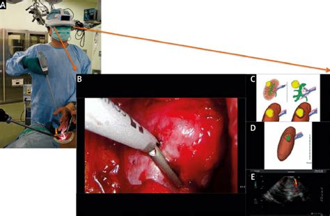 Photo 1 A Scene Of Gasless Single Port Clampless Partial Nephrectomy