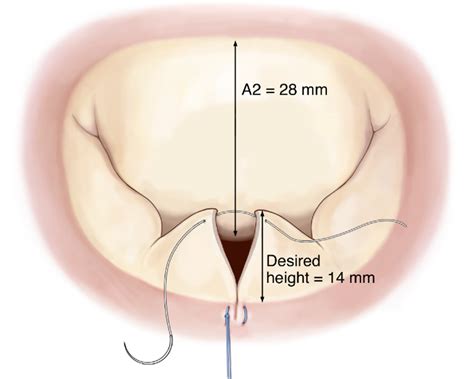 Mitral Valve Prolapse And Repair Northwestern Medicine