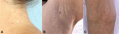 Abaloparatide Induced Pseudoxanthoma Elasticum Jaad Case Reports