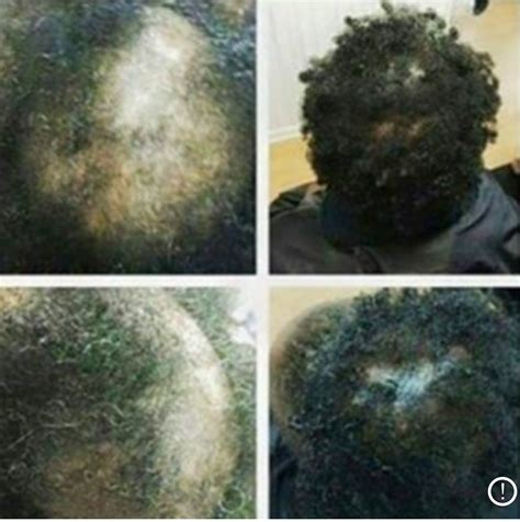 Androgenetic Alopecia Hair Loss Causes In Men And Women