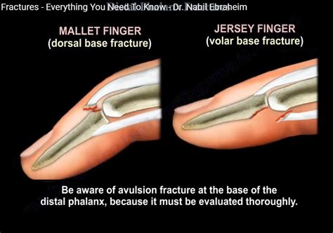 Distal Phalanx Fractures —