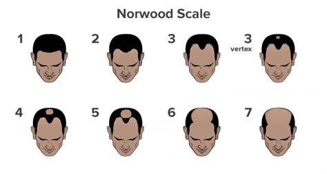 Guide To Male Pattern Hair Loss Androgenic Alopecia Causes Symptoms