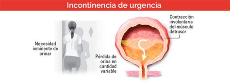 Tipos De Incontinencia Urinaria En Adultos Blog Iberomed