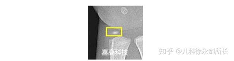 中华05标准读准X光骨龄片最基础知识解析 知乎