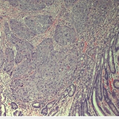 Squamous Cell Carcinoma Of Similar Morphology To Hypopharyngeal