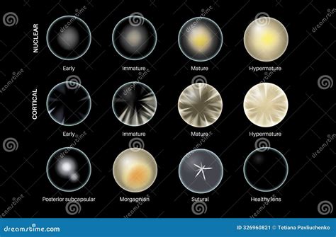 Cataract Eye Disease Cartoon Vector 326960821