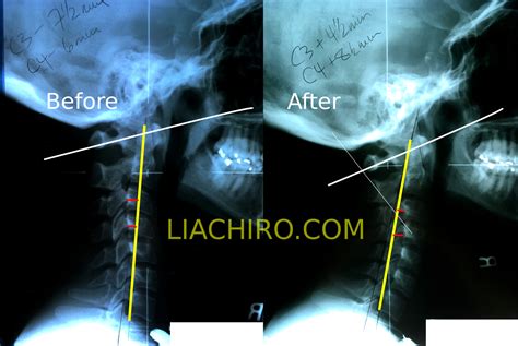 I Have A Reverse Cervical Curve Is This A Problem Can You Fix It