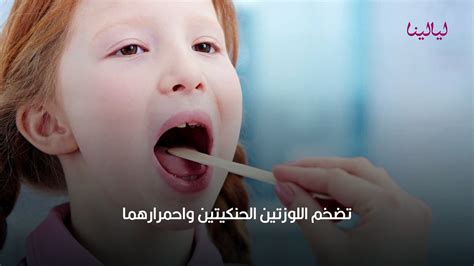 أعراض التهاب اللوزتين عند الأطفال وعلاجه فيديو Dailymotion