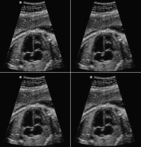 Speckle Reduction In Ultrasound Images Using Nonisotropic Adaptive
