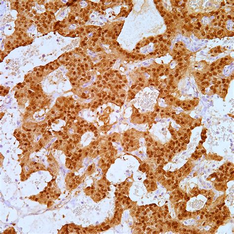 Beta Catenin Pathology Resident Wiki Fandom