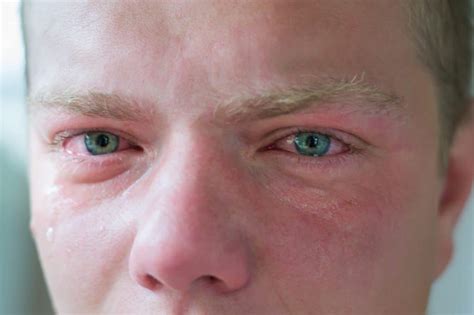 Learn How To Get Rid Of Red Puffy Eyes From Crying