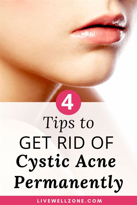 How To Get Rid Of Hormonal Acne Naturally And Reliably A 7 Step Plan For