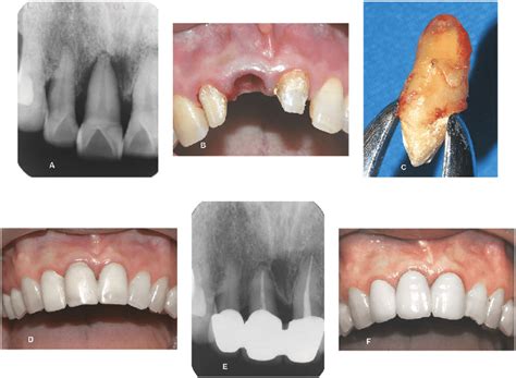 A Periapical Radiograph Illustrated A Severe Angular Bony Defect
