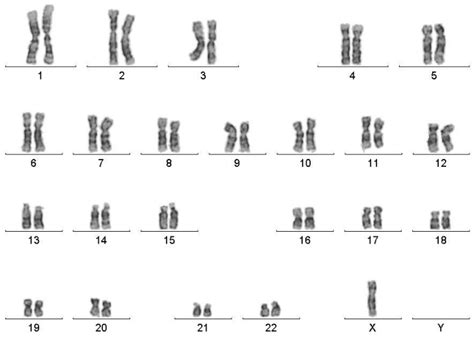Karyotype Showing 45x Chromosomal Complement Download Scientific