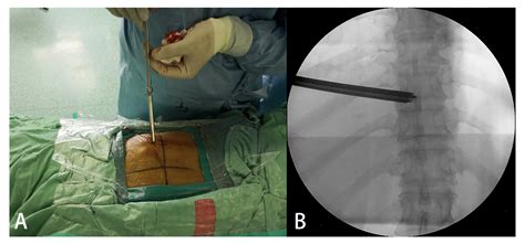 Full Endoscopic Decompression For Thoracic Ossification Of The Ligamentum Flavum Combined With