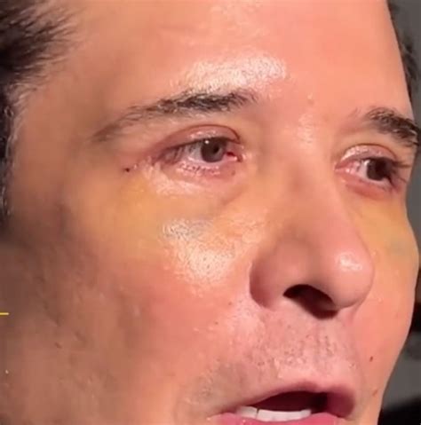 Gustavo Adolfo Infante se somete a nueva cirugía en el rostro envía mensaje ante críticas El
