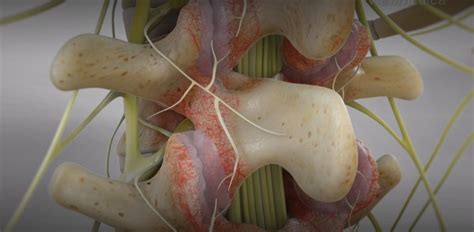 Facet Joint Syndrome Causes Symptoms And Treatment