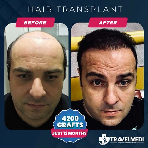 Dhi Hair Transplant Travelmedi