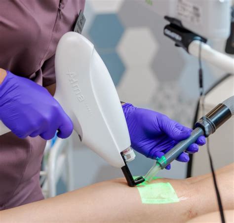 Spider Vein Treatments Spider Veins Australia