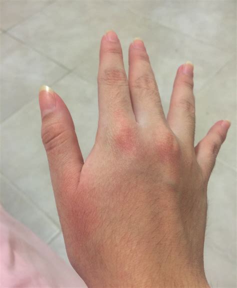 Arriba 93 Foto Que Es Un Ojo De Pescado En La Mano Actualizar