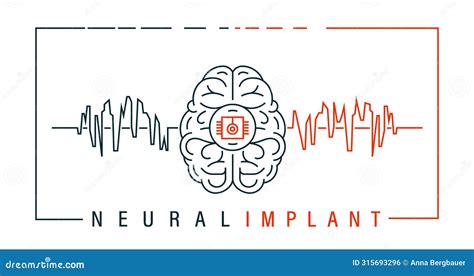 Implantation Of A Neural Chip Into The Human Brain Cartoon Vector