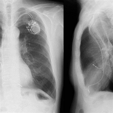 Chest Radiograph 4 Days After Pacemaker Implantation The Chest