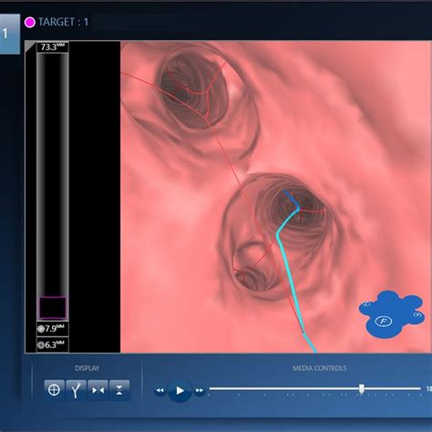Tracheoesophageal Fistula Esophagogram Congenital Tracheoesophageal