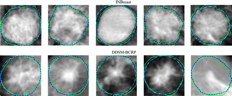 Examples Of Mammography Data Test Set Ground Truth Initial Contour