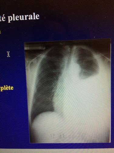 Patho Pulmonaire Cartes Quizlet