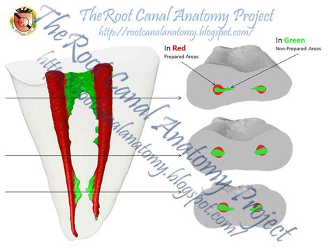 The Root Canal Anatomy Project Rotary Preparation Mandibular Molar