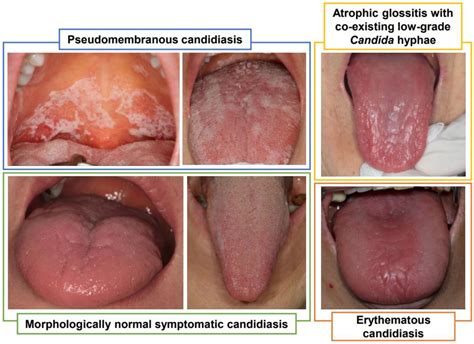 Normal Tongue Vs Thrush