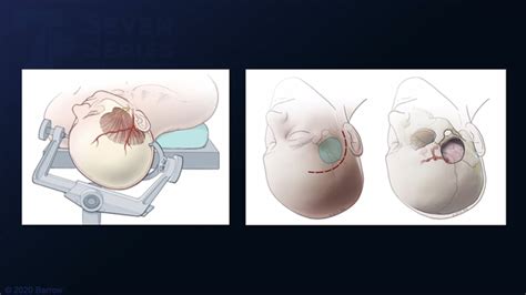111 Microsurgical Clipping Of A Middle Cerebral Artery Mca Aneurysm