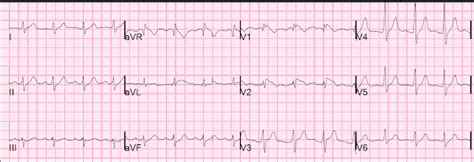Dr Smiths Ecg Blog January 2017