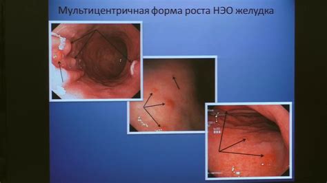 G03Малихова ОА Нейроэндокринные опухоли желудка Алгоритм диагностики и