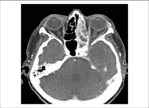 Axial Contrast Ct Scan Of The Head Shows A Heterogeneous Mass In The
