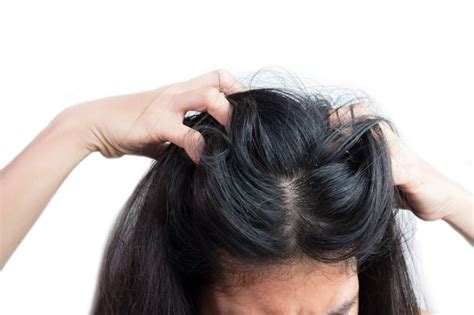 Scalp Yeast Infection Symptoms Causes Treatment And More