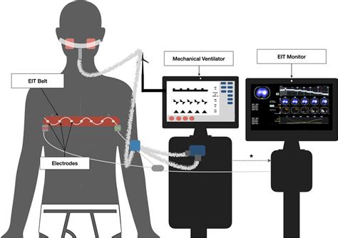 electrical impedance tomography in acute respiratory