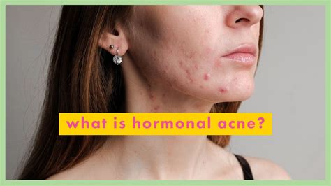 Hormonal Acne Causes Symptoms Treatments