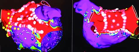 Post Ablation Voltage And Lesions Set The Color Scale For The Voltage