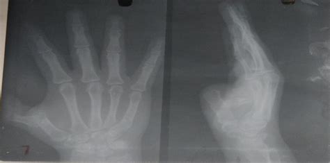 Left Thumb Anteroposterior A And Lateral B Radiographs At Download Scientific Diagram