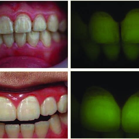 Smooth Surface Caries Detection Using Qlf Technology Taken From [ 6 ] Download Scientific