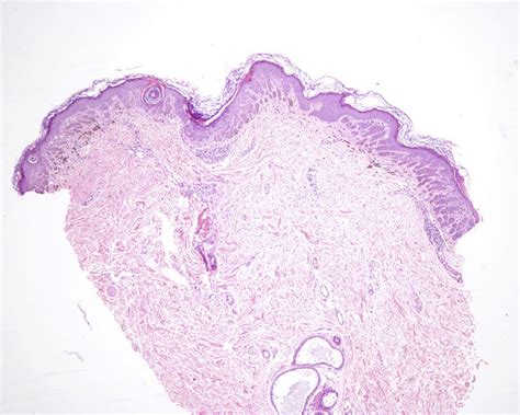 Reticulate Hyperpigmentation Of The Flexures Actas Dermo Sifiliográficas