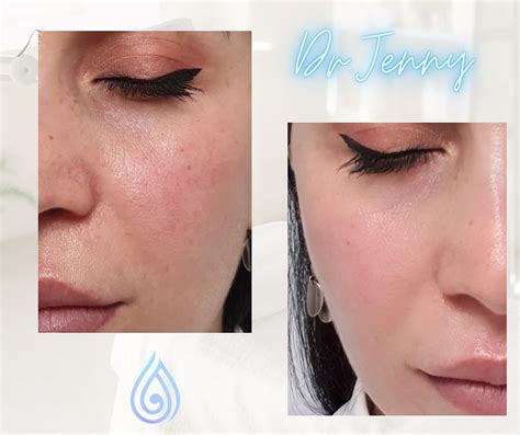 საცრემლე ღარის შევსება Skin Art ინექციური კოსმეტოლოგია