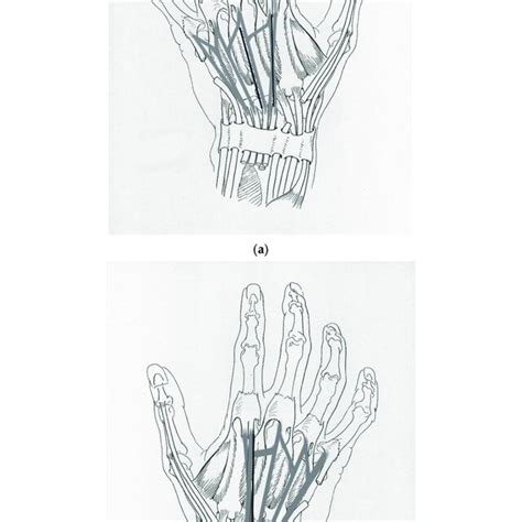 A Schematic Of The Left Hand Highlighting The Juncturae Tendinum