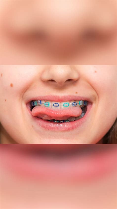 Aesthetic Braces Color Combos Braces Colors Cute Braces Colors Cute